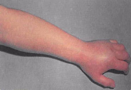 Acute Effects Erythema And Skin Edema Radiation Emergency Medical