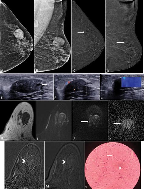 Case 1 Incidentally Detected Nodular Pseudoangiomatous Stromal