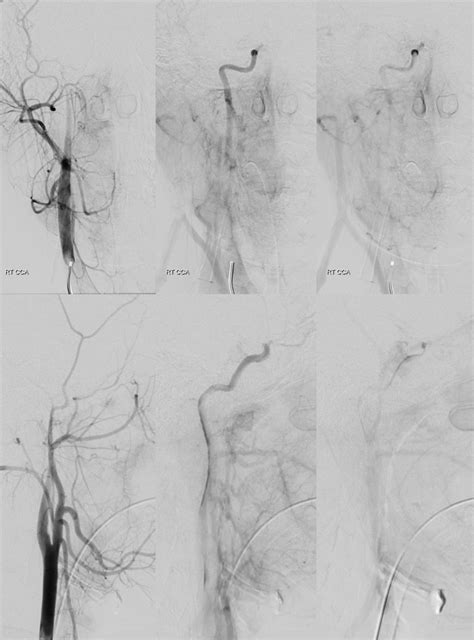 Pediatric Intracranial Dissection