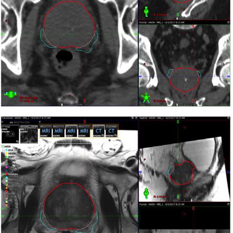 Contour Of The Prostatic Plexus As An Organ At Risk During The Download Scientific Diagram