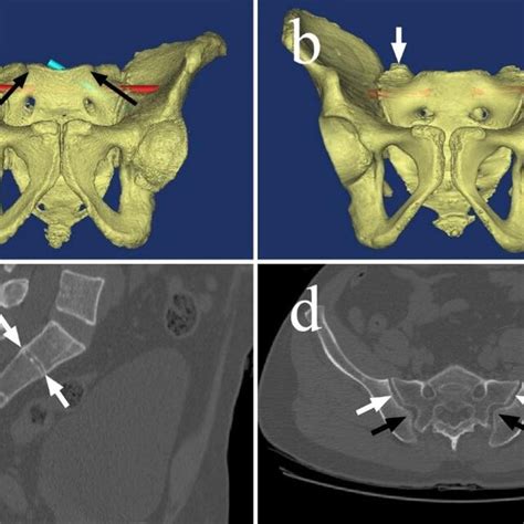 sex specific prevalence of the signs of sacral dysmorphism download