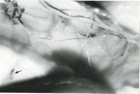 The Vessel Arrow Left Below Which From The Pericallosal Pial Plexus Download Scientific