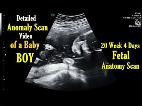 20 Week 4 Days Anomaly Scan In Pregnancy Detailed Anatomy Usg Scan Of