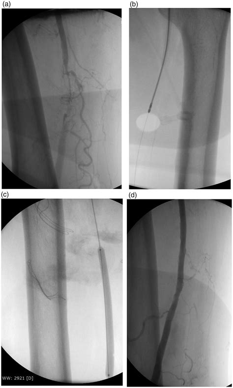 Hybrid Atherectomy For Lower Extremity Peripheral Arterial Disease Saygin Turkyilmaz Ali