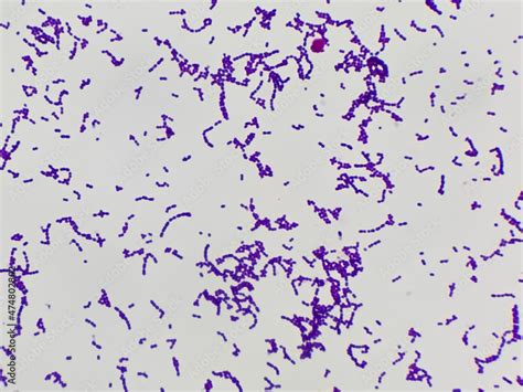 Streptococcus Pyogenes Infected In Aged Patient Showing Of Grams