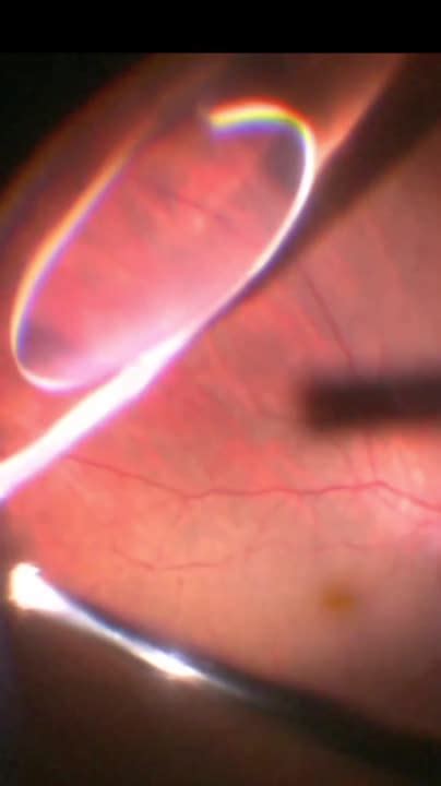 [video] Dr Manish Nagpal On Linkedin Dancing Iol Retrieving A Dislocated Intraocular Lens