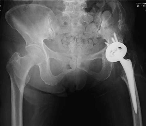 Anteroposterior Radiograph Of Left Hip Showing Well Positioned
