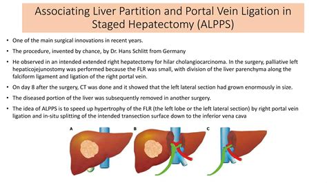 Hepatectomy Pptx