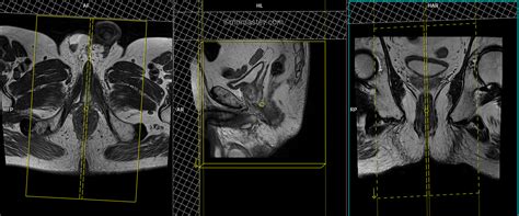 Anal Fistula Mri Perianal Fistula With Contrast Protocol And Planning