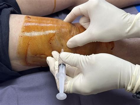 Intra Articular Leukocyte Poor Platelet Rich Plasma Lp Prp Injection Download Scientific