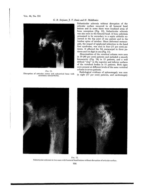 Disruption Of Articular Cortex And Subcortical Bone With Secondary