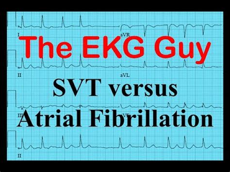 Difference Between Svt And Afib