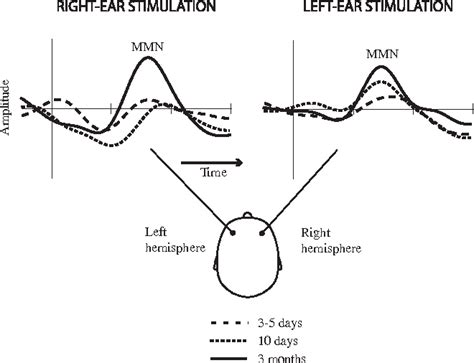Figure 2 From The Mismatch Negativity Mmn A Unique Window To