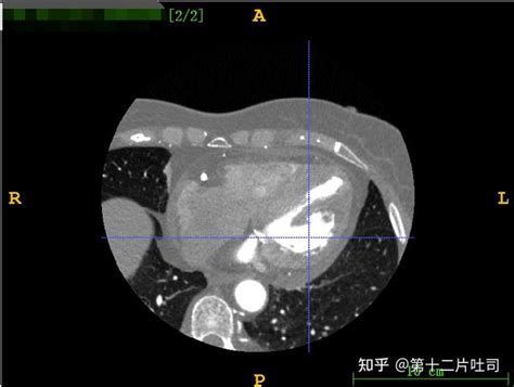 医学影像：itk Snap如何查看 四维”nii文件 知乎