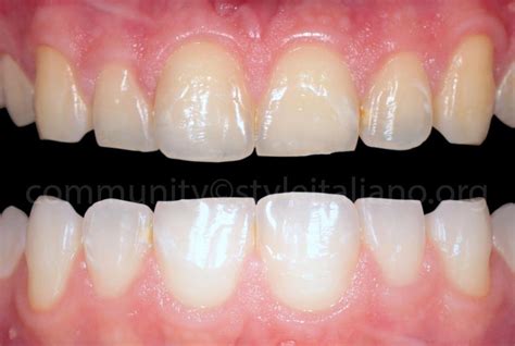 Restoring And Preserving Esthetics Through A Healthy Dynamic Occlusal Function