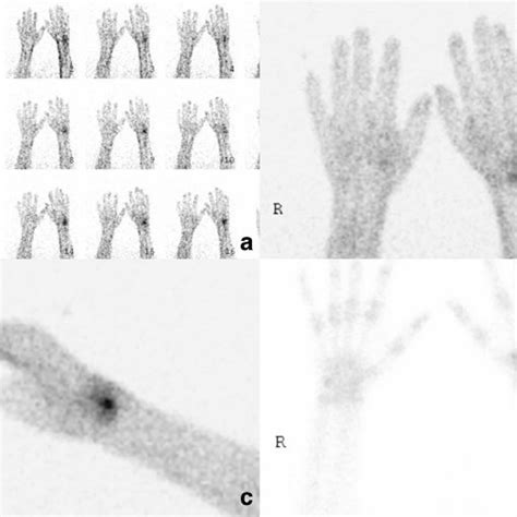 Three Phase Bone Scan Of The Wrists And Hands Performed In 2010 The Download Scientific