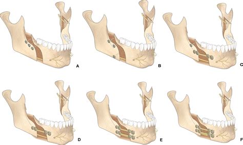 Fixation Methods In Sagittal Split Ramus Osteotomy A Systematic Review