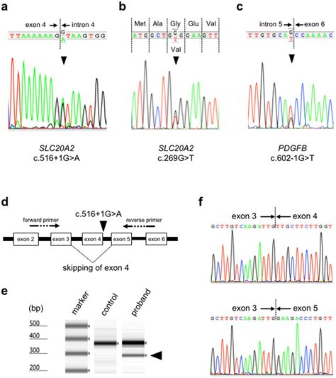 Electropherograms Of Sanger Sequences Of The Proband Of Family A Download Scientific
