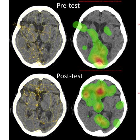 Scan Path And Heat Map Before And After Instruction In A Representative