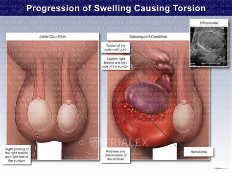 Progression Of Swelling Causing Torsion Trialquest Inc