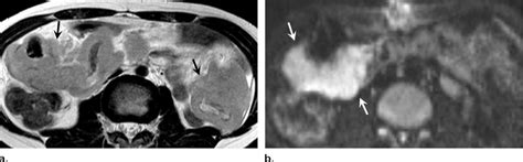 Ptld Of The Small Bowel In A 15 Year Old Girl Who Presented With Weight
