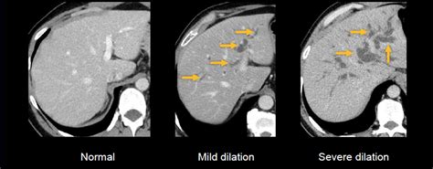 Abdominal Ct Biliary System And Pancreas • Litfl • Radiology