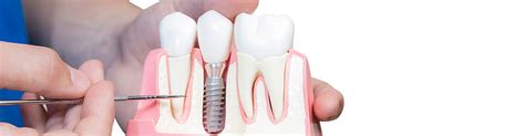 Revolutionizing Smiles With Dental Implant Technology First Choice