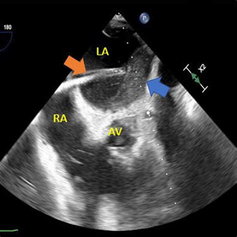 Two Dimensional Tee Modified Basal Short Axis View Demonstrating A
