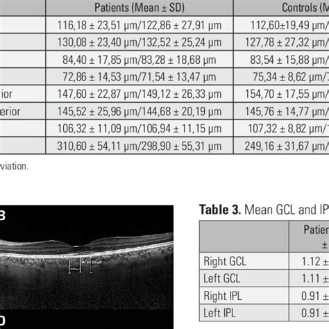 Measurement Of The Gcl And Ipl Thicknesses With Spectral Oct Gcl