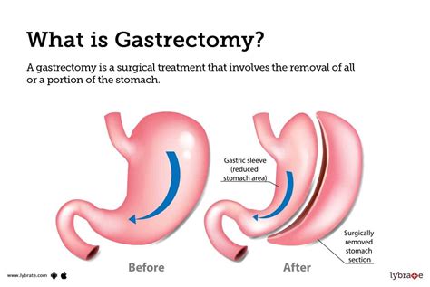 Subtotal Gastrectomy Surgery