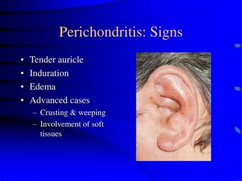 Ear Pinna Perichondritis At Erin Wright Blog