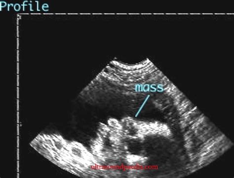 Encephalocele Ultrasound