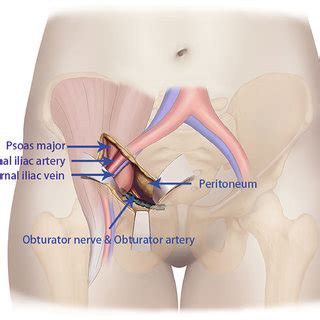 Middle Window Of The Lateral Rectus Approach Download Scientific Diagram