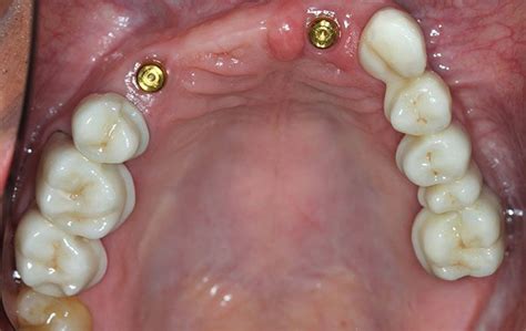 Both Jaws Implant Over Partials Male Dental Implant Center