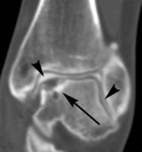 Chapter 3 Radiology Of The Foot And Ankle Musculoskeletal Key