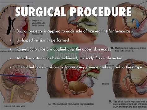 Craniotomy By Nakeeya Goff