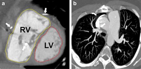 Surveillance Ct In Repaired Tetralogy Of Fallot With Pacemaker A