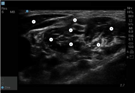 Peripheral Nerve Blocks Diagram Quizlet