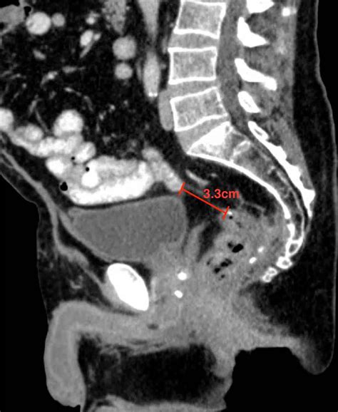 Total Transperineal Laparoscopic Proctectomy For The Treatme