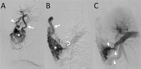 Figure 2 From Chest Wall Systemic Artery To Pulmonary Artery Vascular Malformation Treated By