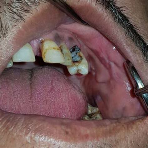 Intraoral View A Nodule In The Left Buccal Mucosa Covered By A Healthy Download Scientific