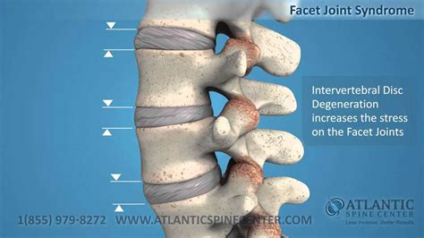 Facet Joint Block Injections Atlantic Spine Center