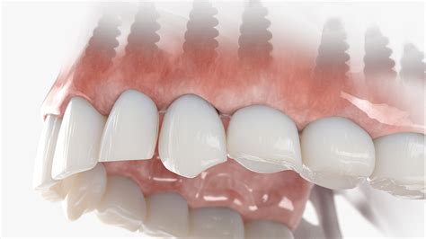 Replacing All Upper Or Lower Teeth Glenbrook Oral And Maxillofacial Surgery