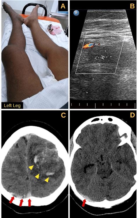 Images From Case Massive Left Leg Edema With Cyanosis A Venous Download Scientific Diagram