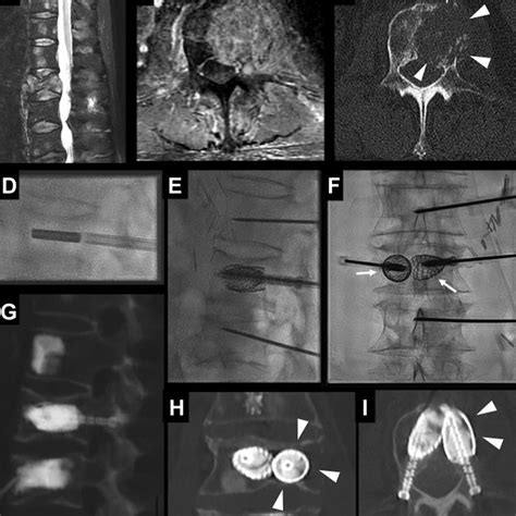 Frankel Grade Classification Download Table