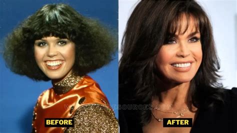 Marie Osmond Plastic Surgery Facelift Nosejob And Nutrisystem Commercial