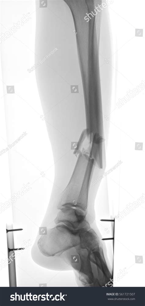 Xray Image Leg Showing Tibia Fibula Stock Photo Edit Now 561721507