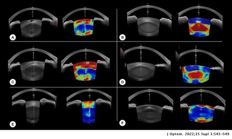 Development And Validation Of A Pixel Wise Deep Learning Model To