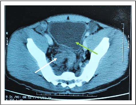 Figure 1 From Plexiform Neurofibroma Masquerading As A Seminal Vesicle Mass A Case Review