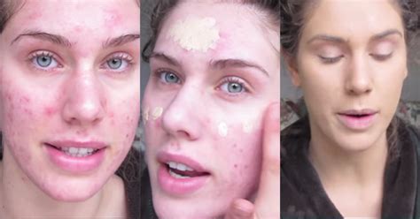 If Youve Ever Had Acne Scars Youd Know That These Tricks Never Really Worked